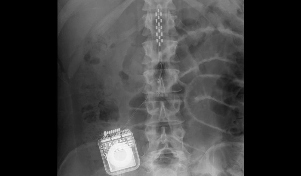 Reawakening Limbs After Years of Paralysis - Science Friday