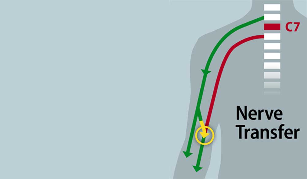 Rerouting Working Nerves to Restore Hand Function - Science Friday