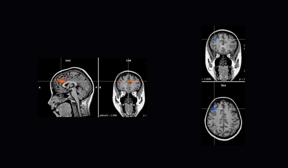 What Your Brain Looks Like When You Lose Self-Control - Science Friday